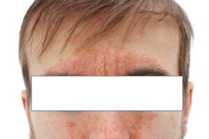 How to Spot an Alcoholic Face - With Pictures - Ocean State Recovery Center