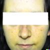 How to Spot an Alcoholic Face - With Pictures - Ocean State Recovery Center