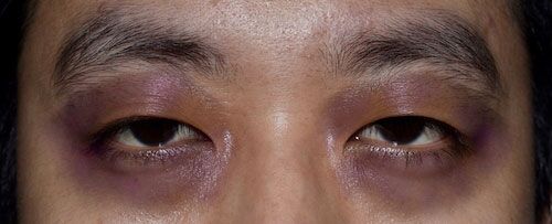 How to Spot an Alcoholic Face - With Pictures - Ocean State Recovery Center